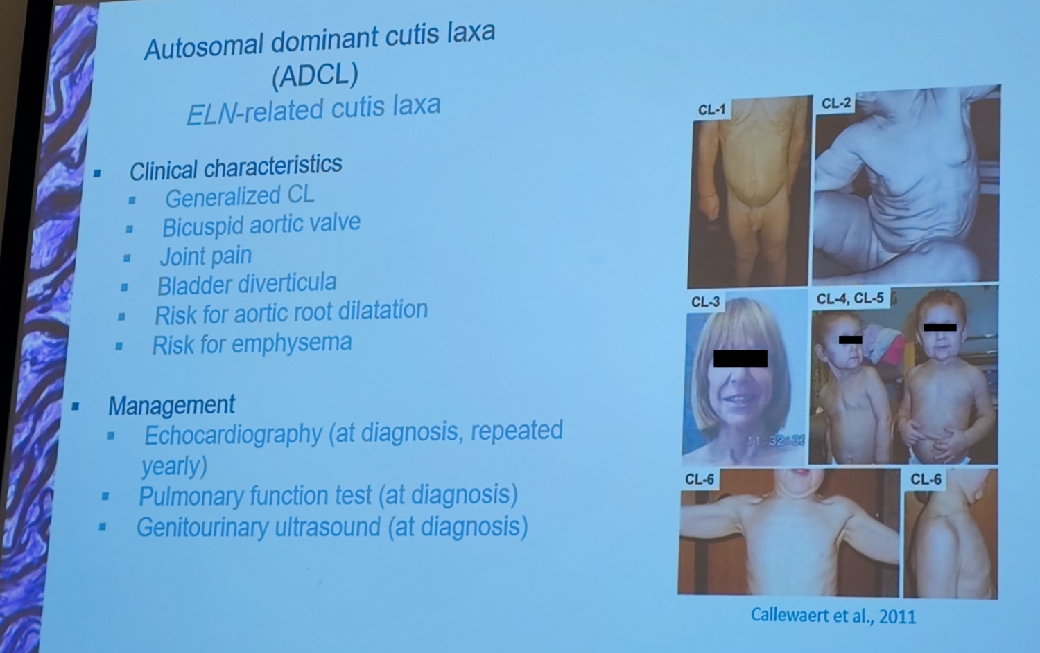 Mrs Aude Beyens, MD (Ghent, Belgium): Structural defects of Connective ...