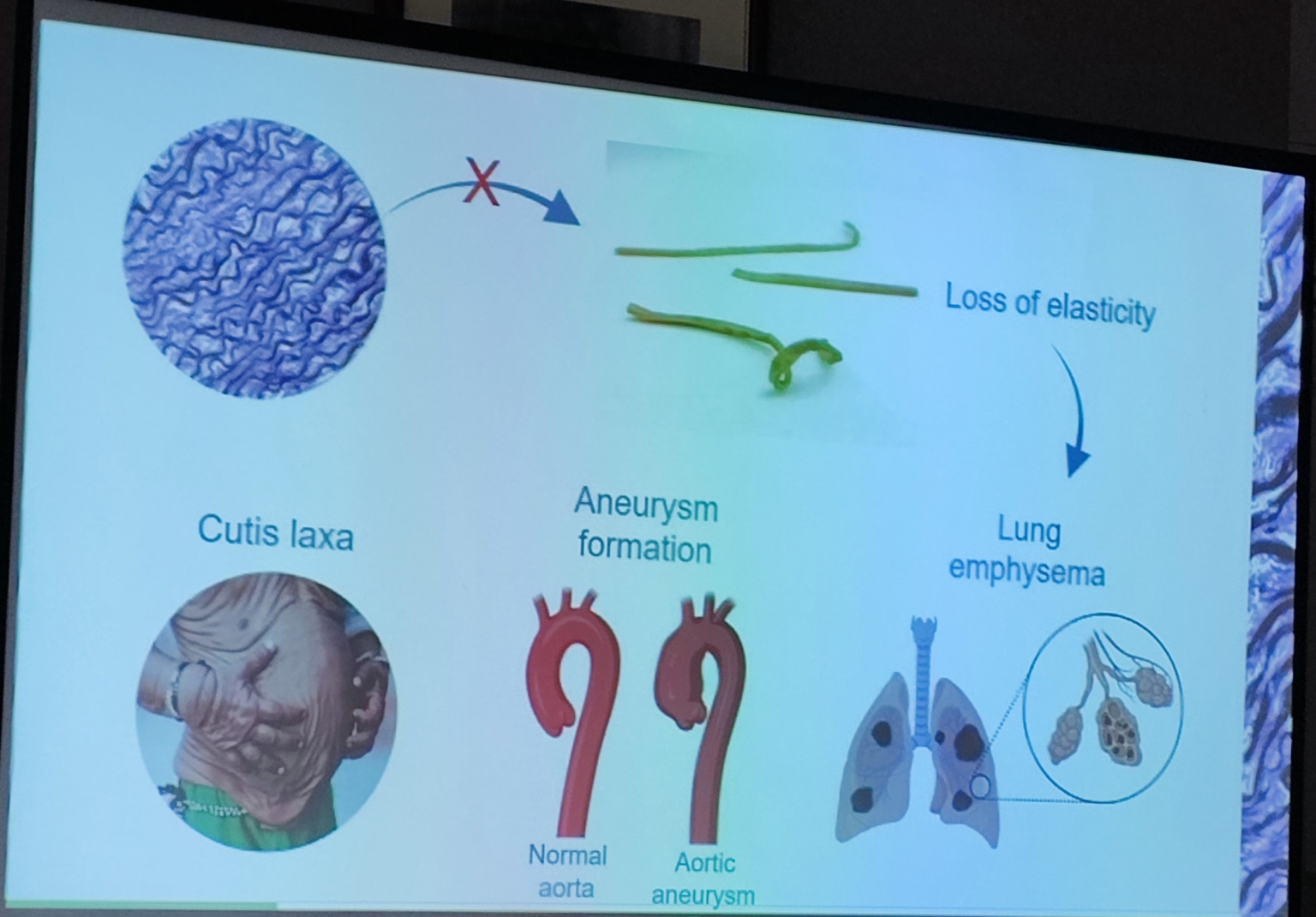 Cutis Laxa : ¿qué ocurre? - CUTIS LAXA INTERNATIONALE